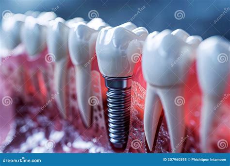 Dental Implantation Teeth With Implant Screw Ai Generative Stock