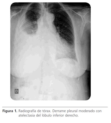 Hemoptisis Y Derrame Pleural Derecho Secundario A Amiloidosis