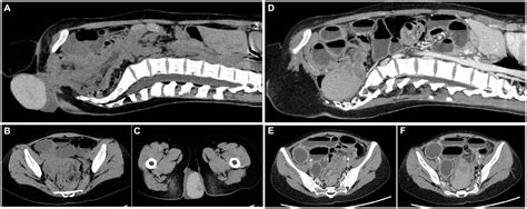 Frontiers A Case Report Of A Giant Ileocecal Cystic Prolapse Through