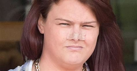 Woman Has Part Of Her Nose Bitten Off By Former Friend During Funeral