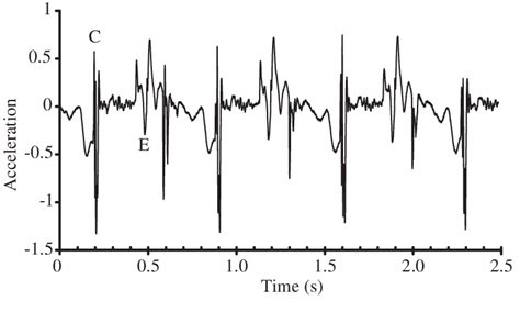 A Representative Accelerometer Recording Showing The Very Pronounced