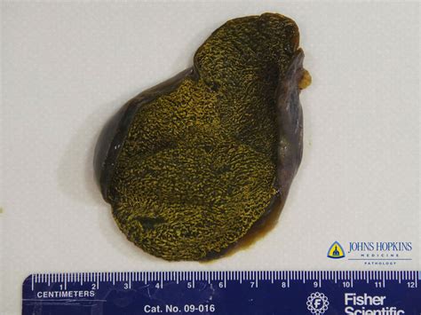 Chronic Cholecystitis With Cholesterolosis Surgical Pathology Photo