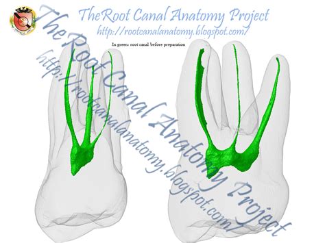 The Root Canal Anatomy Project Conservative Endodontic Access Maxillary Molar
