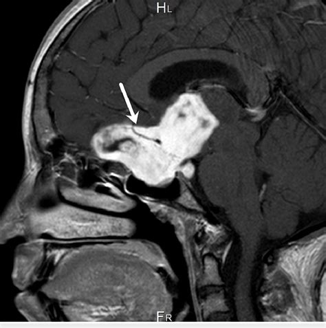 T1 Weighted Brain Mri Post Contrast Sagittal View Shows The Large