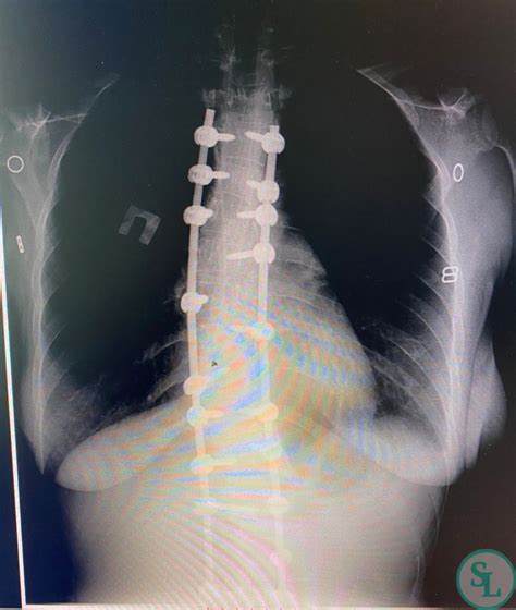 Идиопатический декомпенсированный S образный грудо поясничный сколиоз