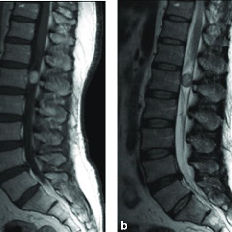 Magnetic Resonance Imaging Features An Oval Intradural Lesion At L1 Download Scientific Diagram