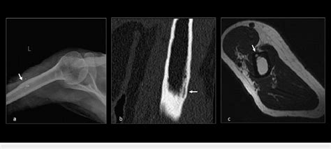 X Ray Ct And Mri Evaluation Of The Left Shoulder A Frontal