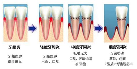 牙龈萎缩应该怎么办？