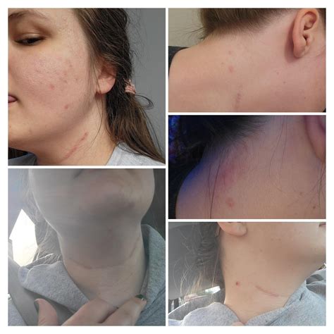 One Year Ago I Had A Bilateral Styloidectomy To Remove 6 Cm Calcified