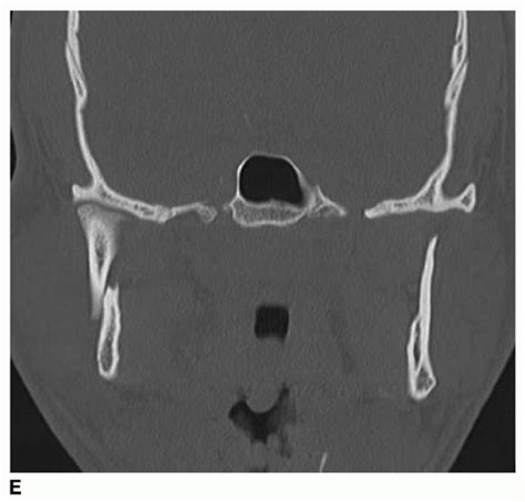 Mandibular Fractures Ento Key