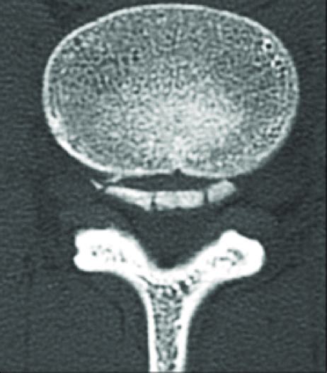 Axial Computed Tomography Image Of An Apophysial Ring Fracture