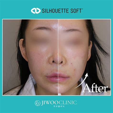 지우클리닉ㅣ강남역피부과ㅣ리프팅 색소치료 쥬브젠 🇨🇳🇯🇵고객님의 특별한 선물 소중한 고객님께서 전해주신 따뜻한 마음 💝 지우 클리닉을 믿고 찾아주시는 것만으로도 큰