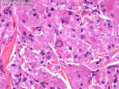 Granular Cell Tumor Pseudoinclusions