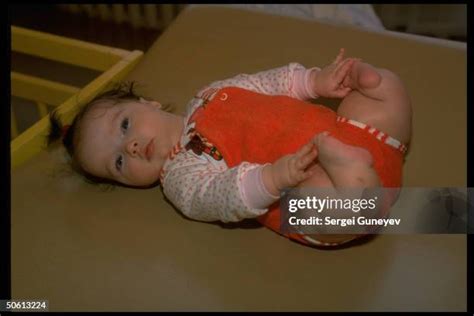 Birth Defects In Babies