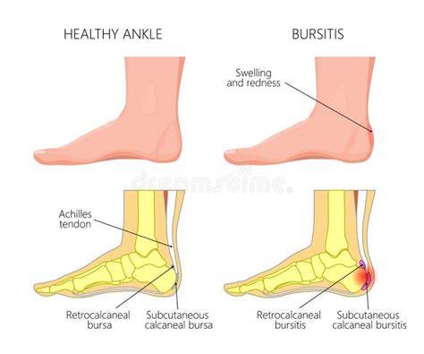 Achilles Bursitis Stock Illustrations 44 Achilles Bursitis Stock