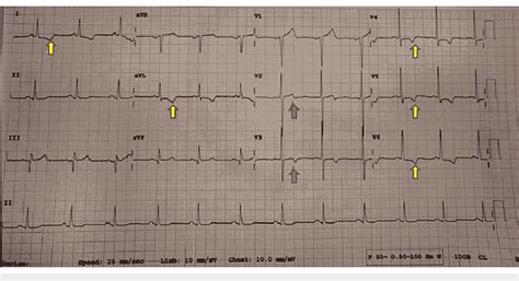 Biphasic T Waves In Lead V2 And V3 Red Arrows Typical Of Type 1