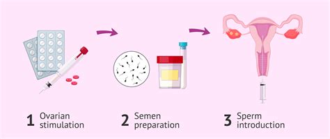 Intrauterine Artificial Insemination