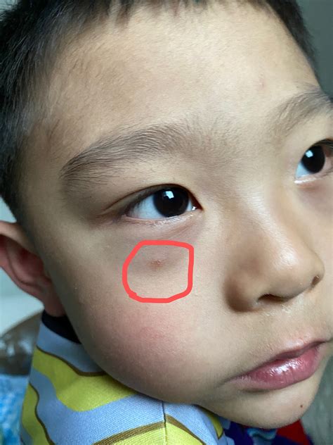 北京丽合胎记科：儿童手臂上大面积黑毛痣可以大点去除吗 哔哩哔哩