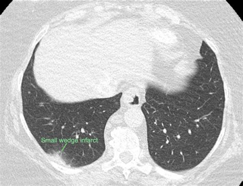 Ct Case 009 • Litfl • Ct Scan Interpretation