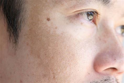 Sun Damaged Skin