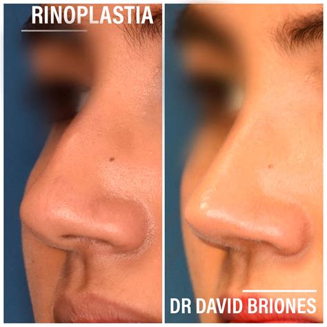 Especialista en rinoplastia en San Luis Potosí Mínima Invasión