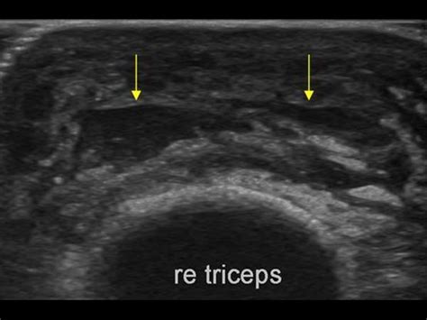 Musculoskeletal Joints And Tendons 62 Elbow Case 625 Olecranon