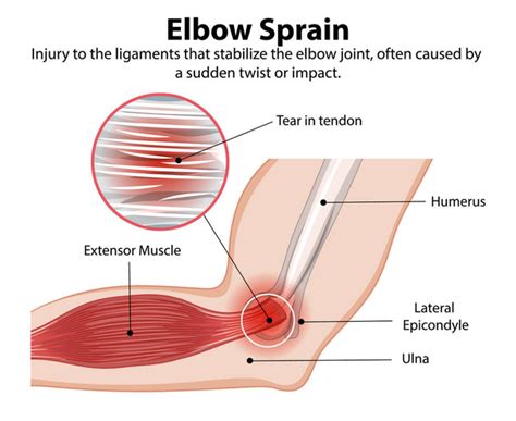 Extensor Muscle Free Stock Vectors