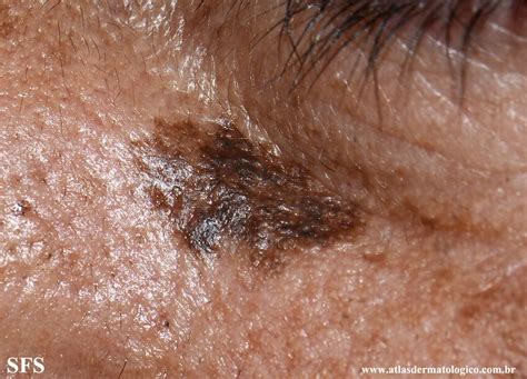 Lentigo Maligna Melanoma Nc Commons