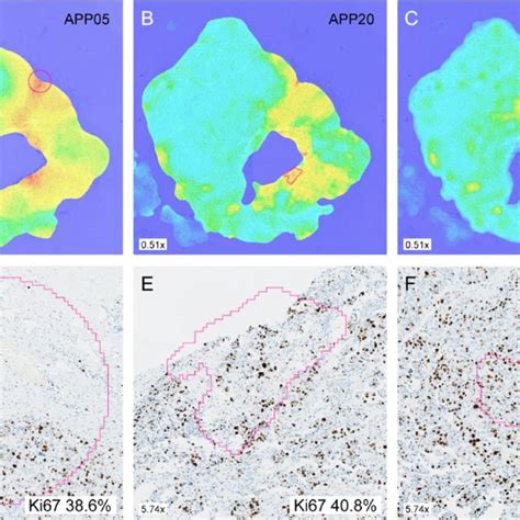 Automated Ki67 Scoring Algorithm In Qupath Illustrated By A Ki67 Download Scientific Diagram