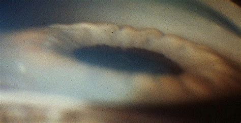 Glaucoma Angle Closure Glaucoma Flashcards Quizlet