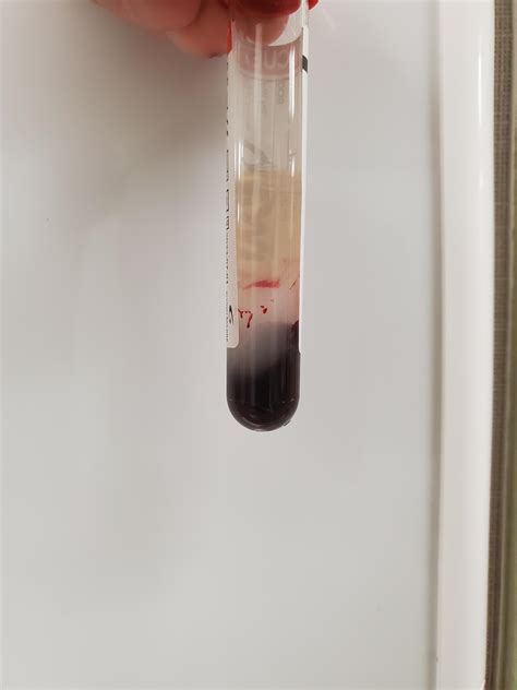 Med Saph On A 16yo Hyperthyroid Cat Check Out That Serum 🤓 R Vettech