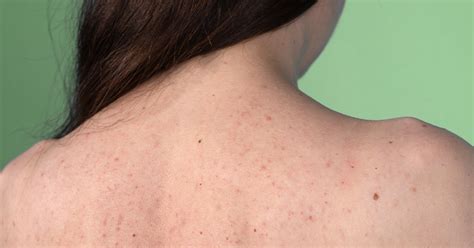 Hormonal Acne Causes Symptoms And Treatment Options Ova Sg