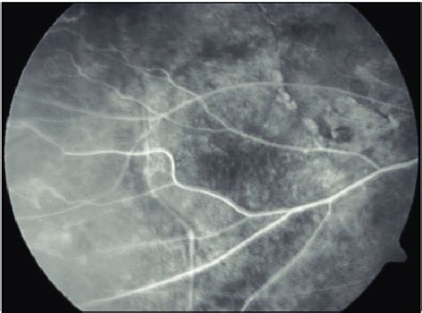 Peripheral Retinal Ischemia In The Temporal Quadrant Of The Right Eye Download Scientific Diagram