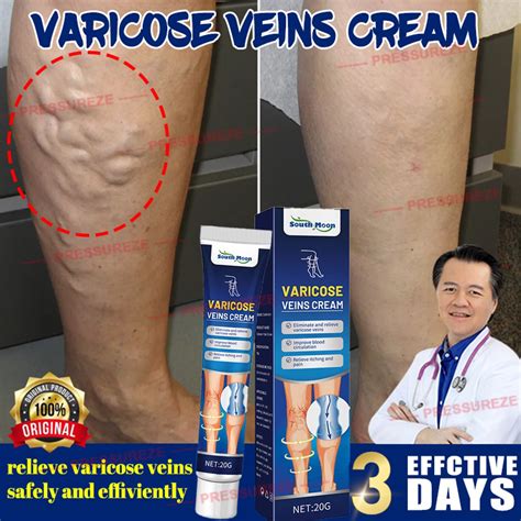 Varicose Veins Cream Varicose Veins Treatment For Legs Natural