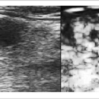 On The Left Side A Gray Scale US Image B Mode Of The Lymph Node In Download Scientific