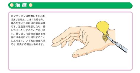 ガングリオンの治療について クリニックの特徴 長府みらいクリニック