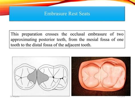 Preparation Of Abutment Teeth Pptx