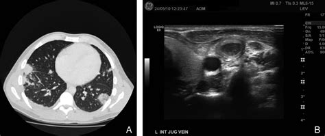 Just A Sore Throat Uncommon Causes Of Significant Respiratory Disease