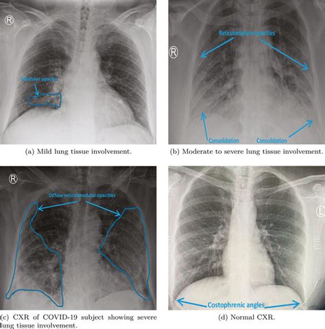 Cxr Images With Various Levels Of Lung Tissue Invovlement Download