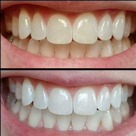 Want These Amazing Results From Just Brushing Affordable Safe And