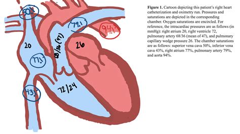 Sinus Venosus Defect With Partial Anomalous Pulmonary Vrogue Co