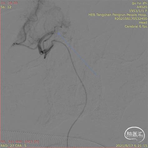 经桡动脉入路 基底动脉、大脑中动脉取栓技术荟萃（双蛇技术、 6fneuron™ Max长鞘应用 脑医汇