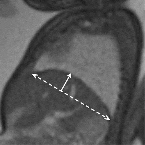 Measurement Of Craniocaudal Anteroposterior Ratio In A Female Fetus At Download Scientific