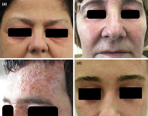 Exfoliative Dermatitis Face