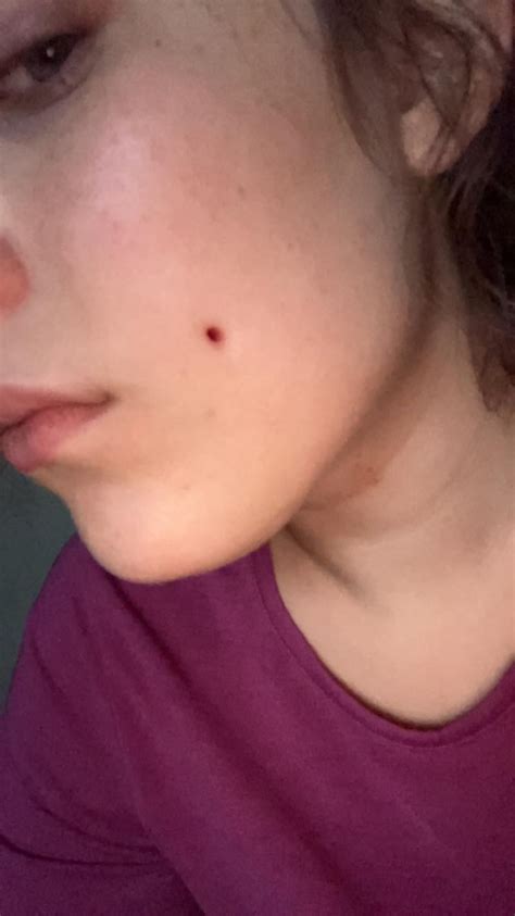 Dimple Piercing Update W Pictures R Stretched