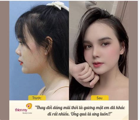Mục Sở Thị Nhan Sắc Thay đổi Ngoạn Mục Của Chị Kh Sau Khi Nâng Mũi Tại