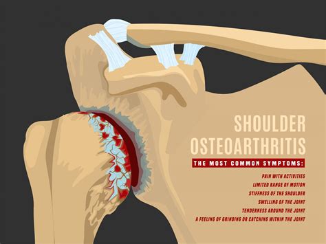 Shoulder Osteoarthritis Pain Solutions Medical