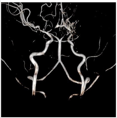 Irm C R Brale S Quences Tof Reconstruction D Illustrant Le Syndrome