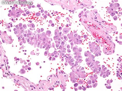 Micropapillary Adenocarcinoma