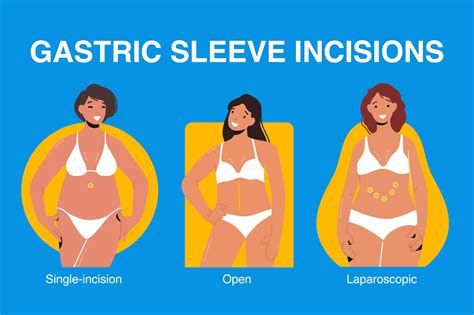 Gastric Sleeve Incisions Insights And Recovery Tips
